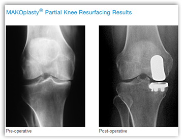 MakoPlasty Robotic Surgical Procedure for Knee Replacements - Health ...